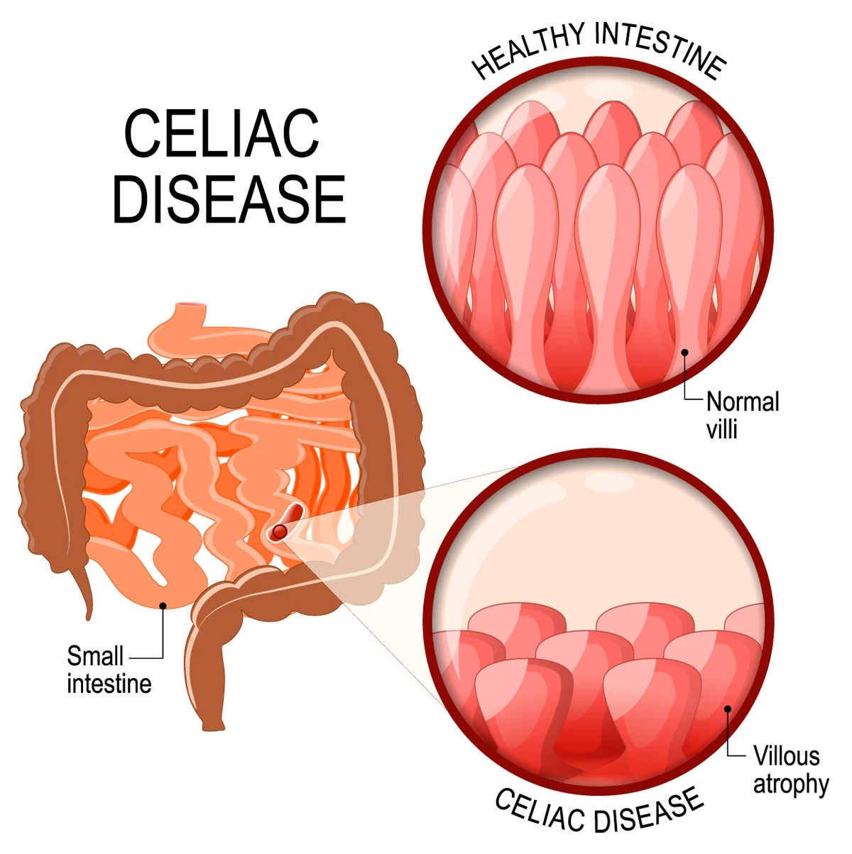 Celiac Disease & Wheat Allergy in Kids: Symptoms, Causes & Treatment ...